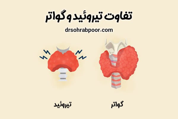 تفاوت تیروئید و گواتر راه های تشخیص آن ها دکتر سعید سهراب پور 5313